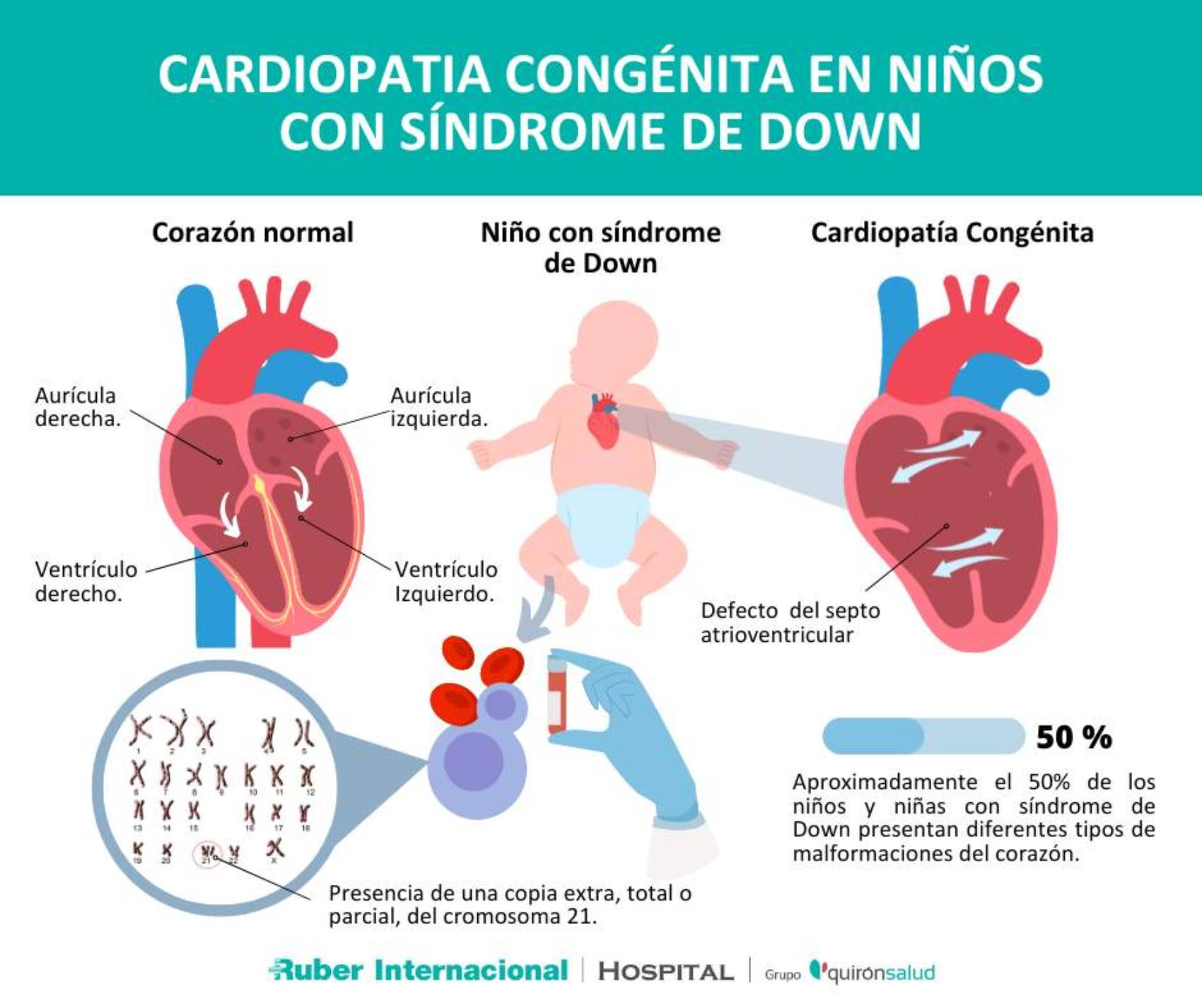 Atención Integral de la Cardiopatía Congénita en niños con Síndrome de Down
